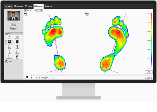 Using Footscan for Physiotherapy
